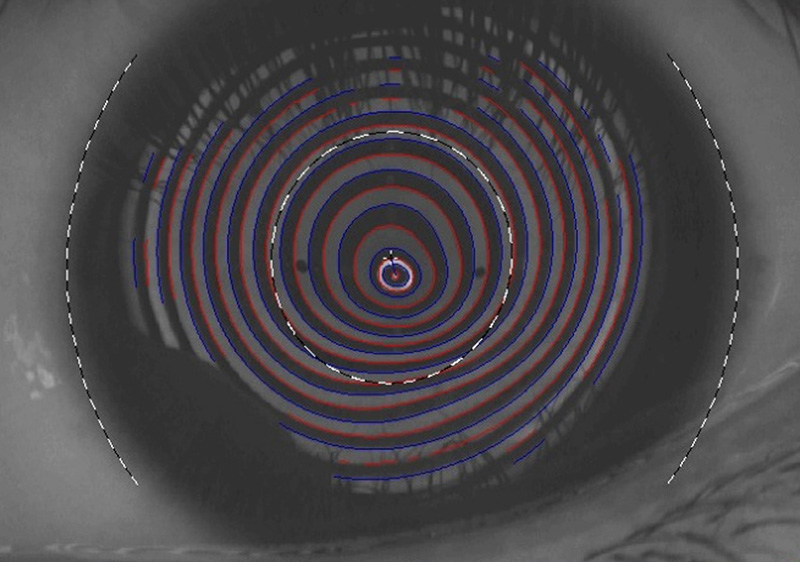 Community Eye Health Journal » Keratoconus: diagnosis and management