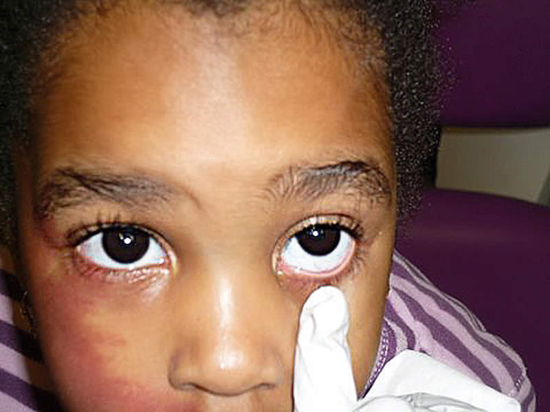 Community Eye Health Journal » Instilling eye drops and ointment in a ...