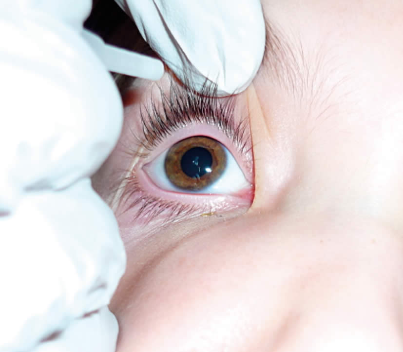 Community Eye Health Journal » Instilling eye drops and ointment in a ...