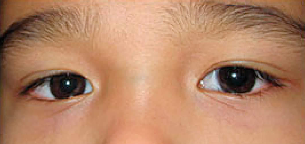 Community Eye Health Journal » Understanding, detecting and managing ...