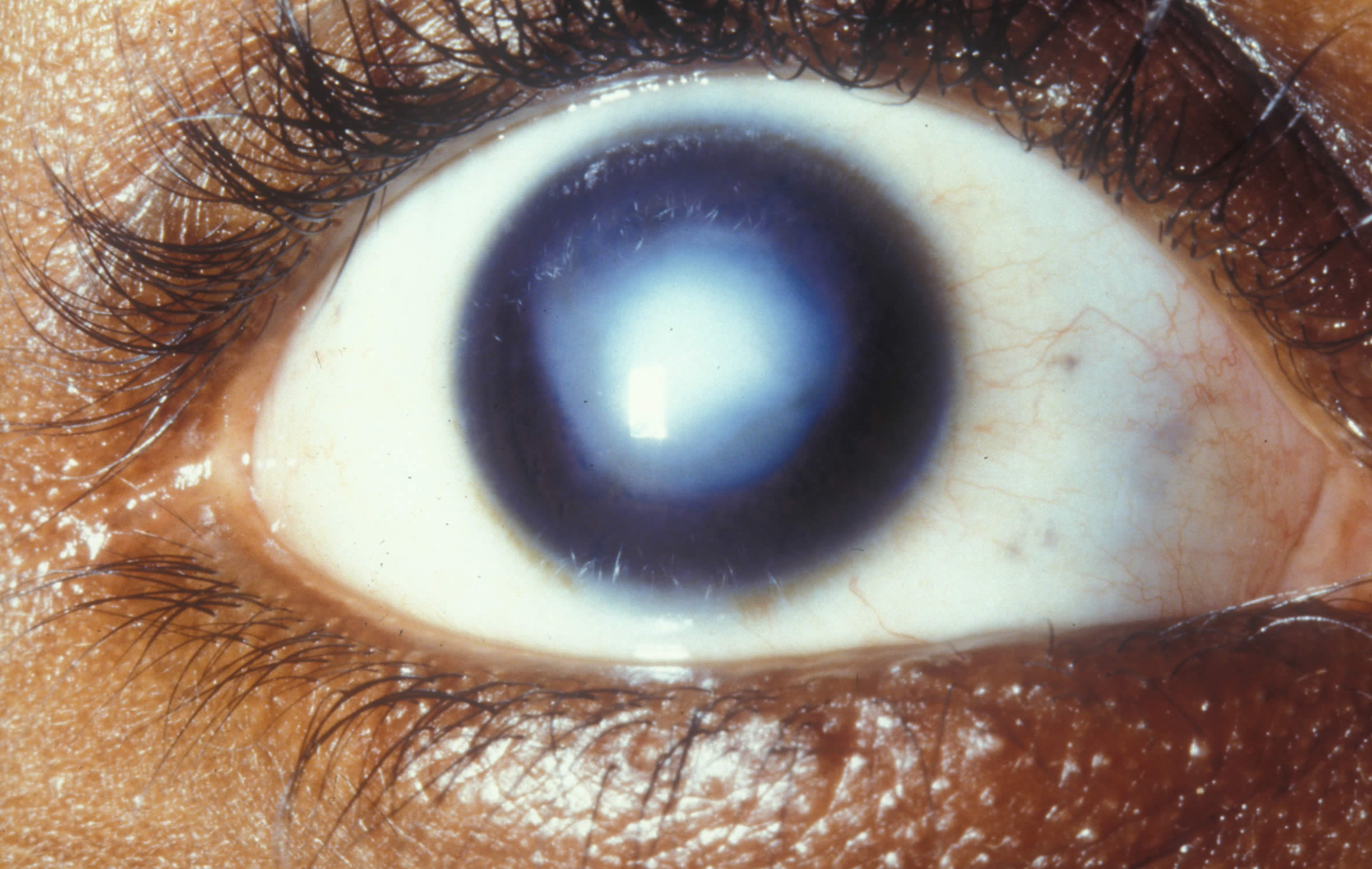 Community Eye Health Journal » Managing eye health in young children