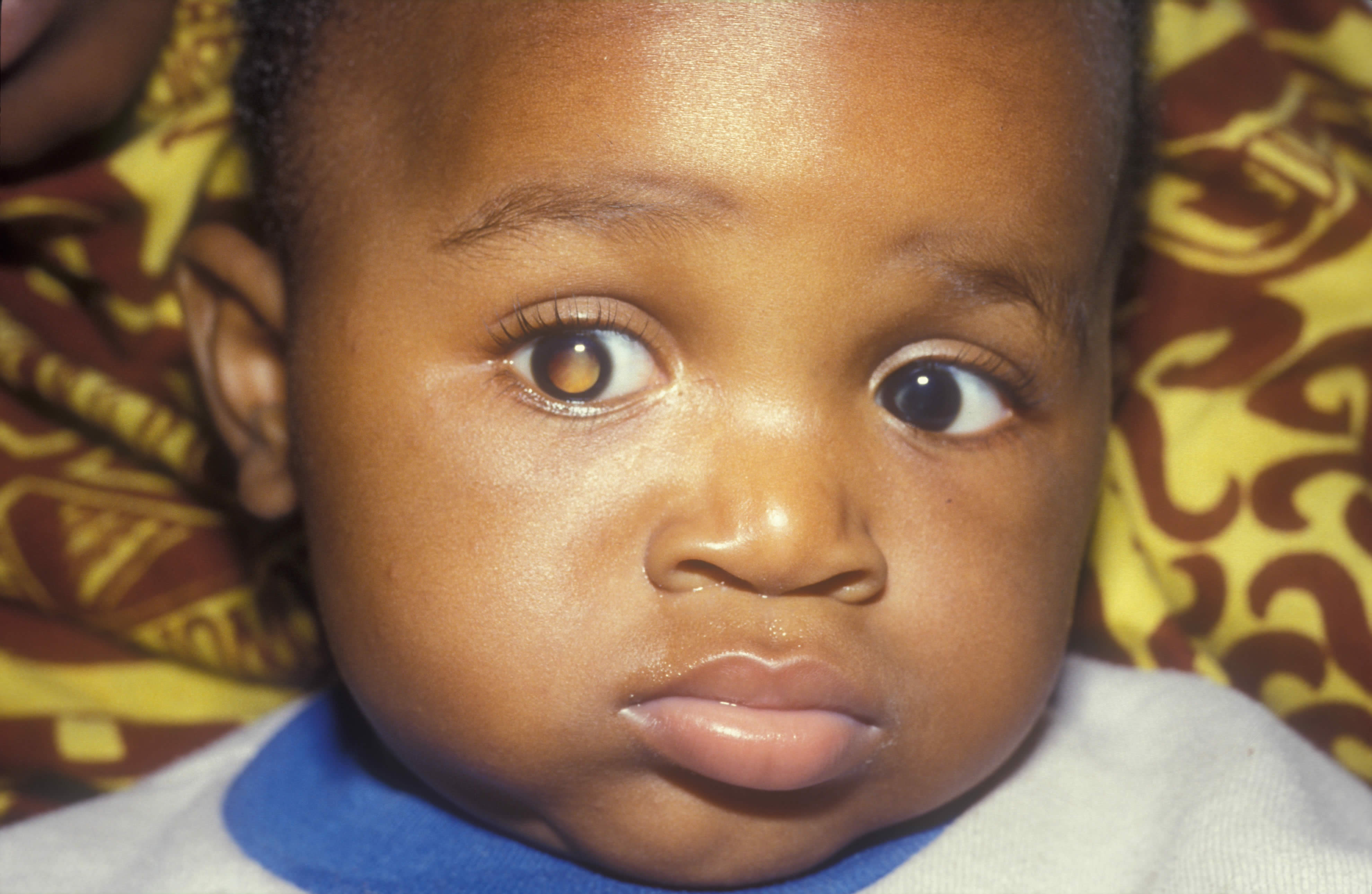 Community Eye Health Journal » Managing eye health in young children
