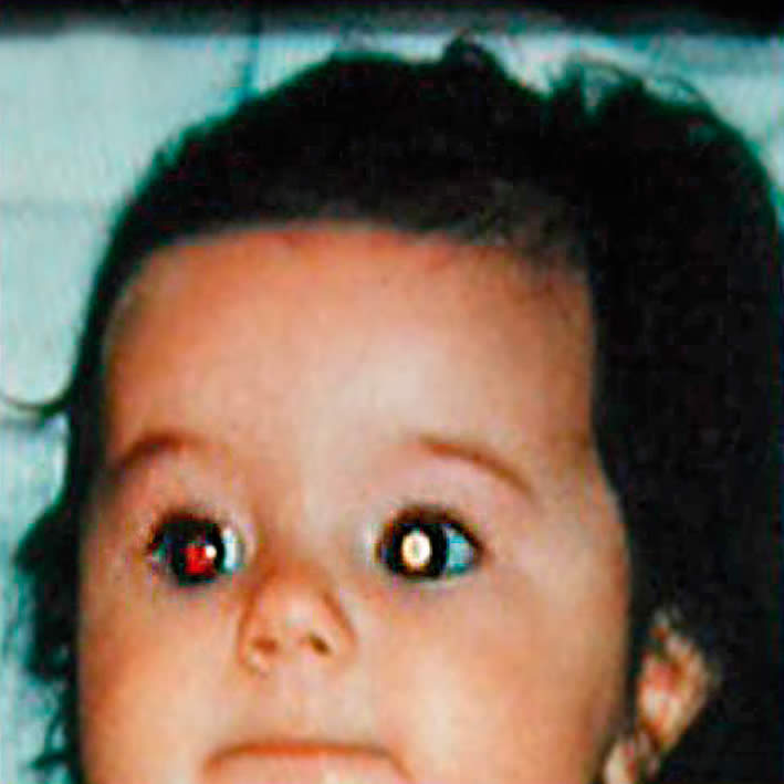 Community Eye Health Journal » Managing eye health in young children