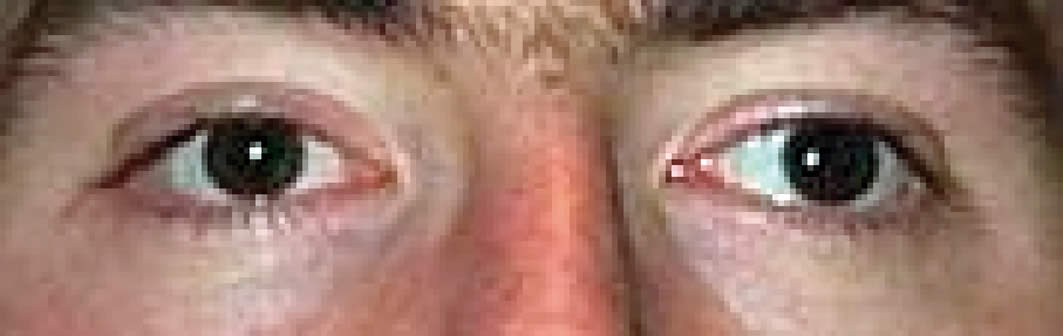 Community Eye Health Journal » Understanding, detecting and managing ...