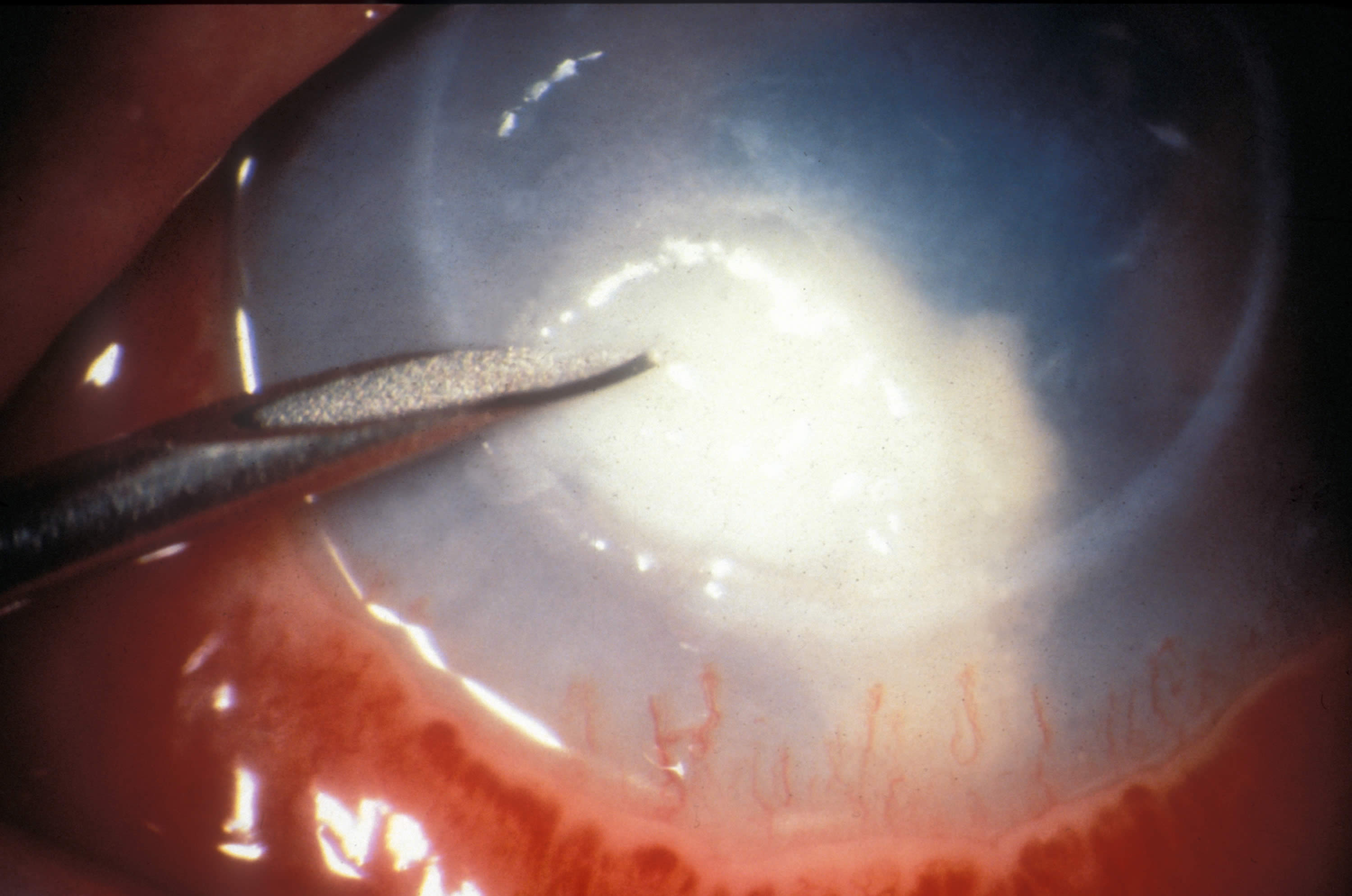 Community Eye Health Journal » Taking a corneal scrape and making a ...