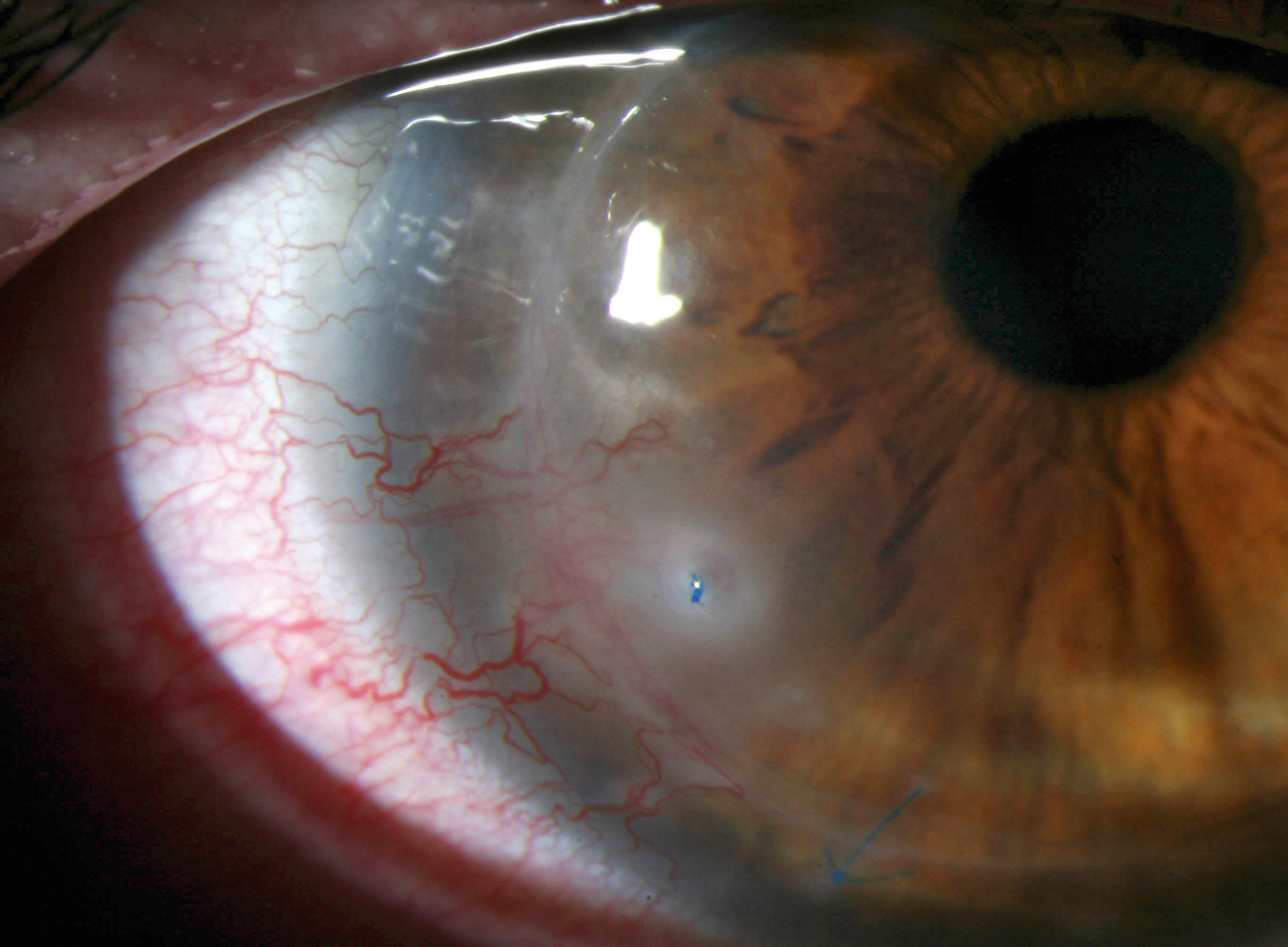 Community Eye Health Journal » Corneal grafting: what eye care workers ...