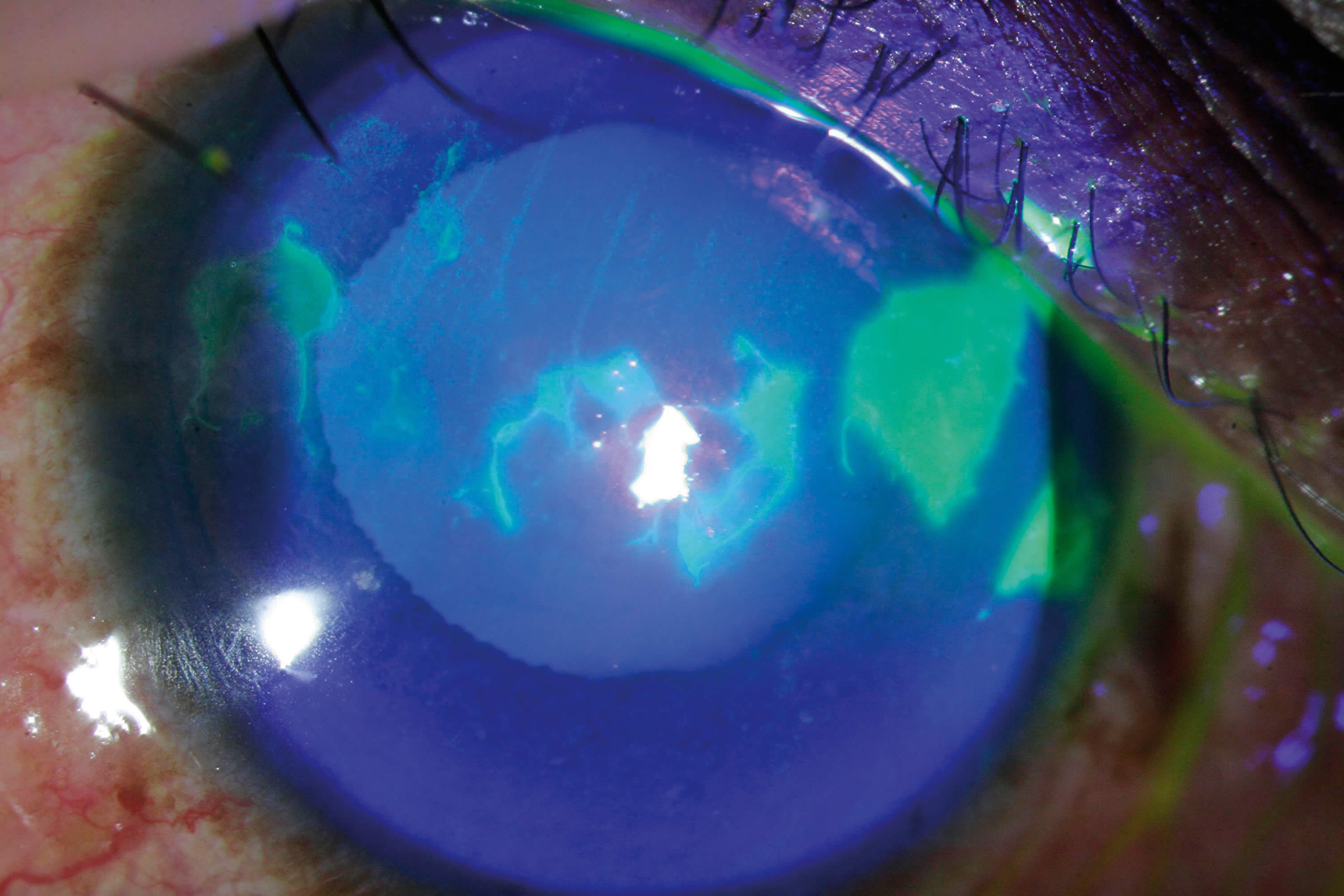 Community Eye Health Journal » Managing corneal disease: focus on ...