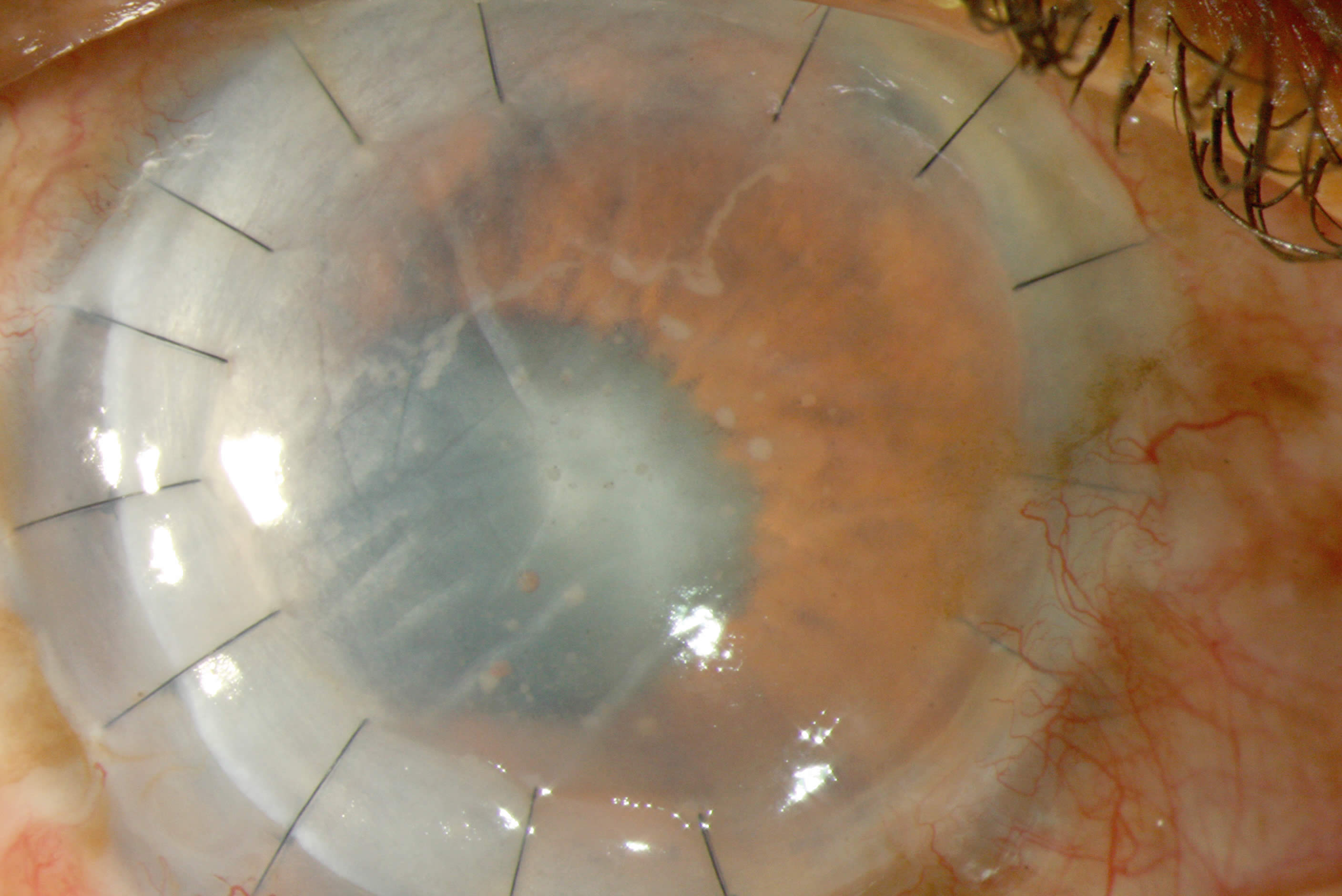 Community Eye Health Journal » Corneal grafting: what eye care workers ...