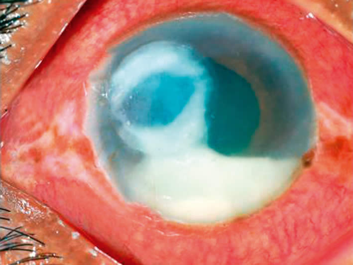 Community Eye Health Journal » Managing corneal disease: focus on ...