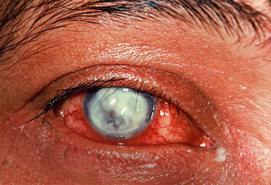 Community Eye Health Journal » Managing corneal disease: focus on ...