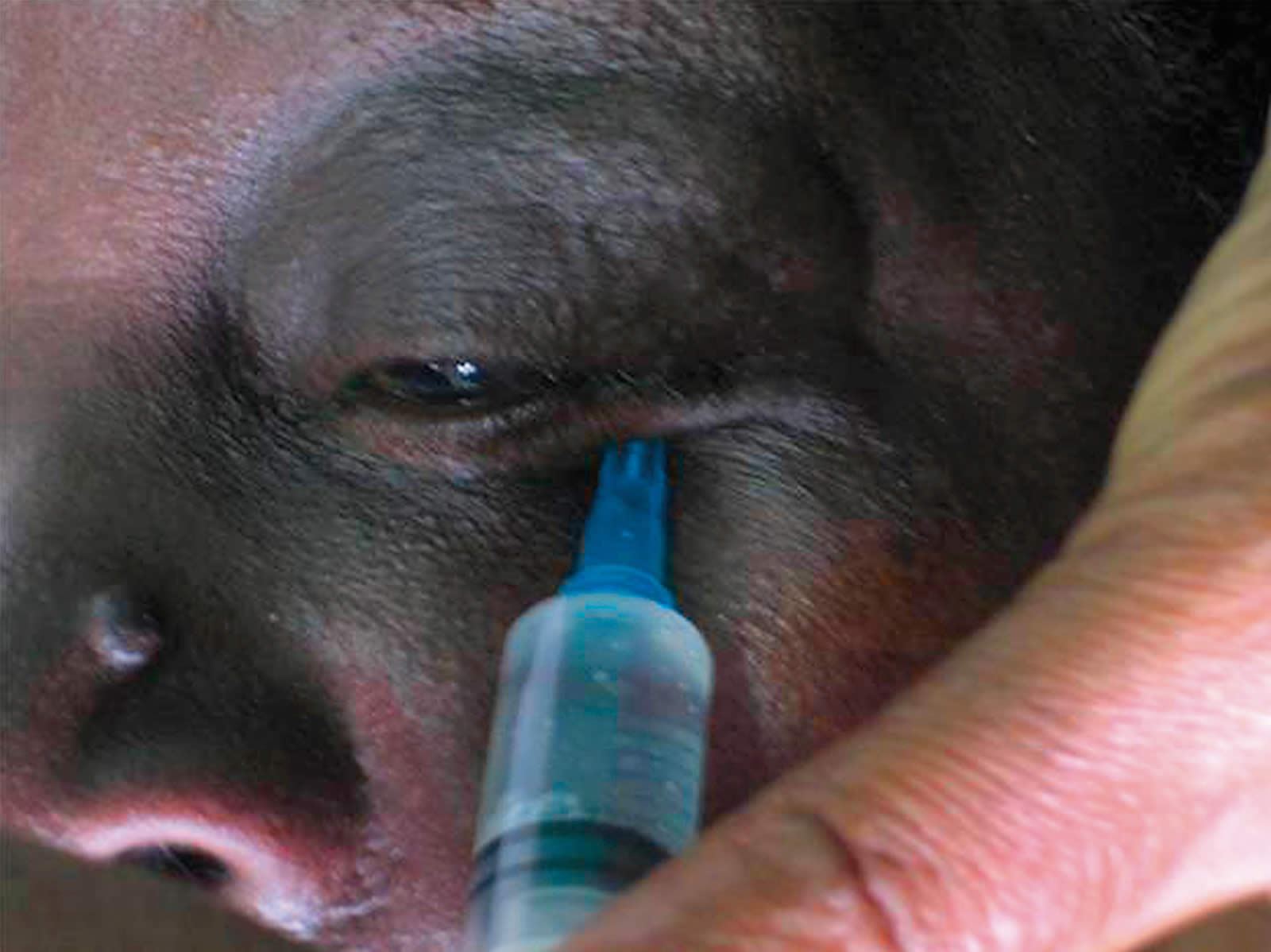 Community Eye Health Journal » Administering an eye anaesthetic ...