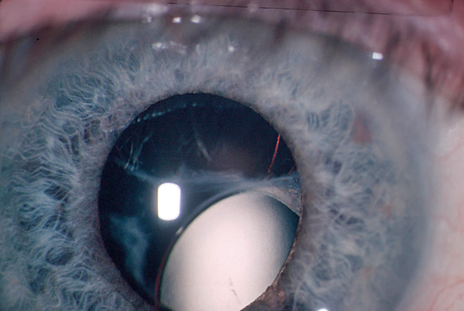 Community Eye Health Journal » Recognising ‘high-risk’ eyes before ...