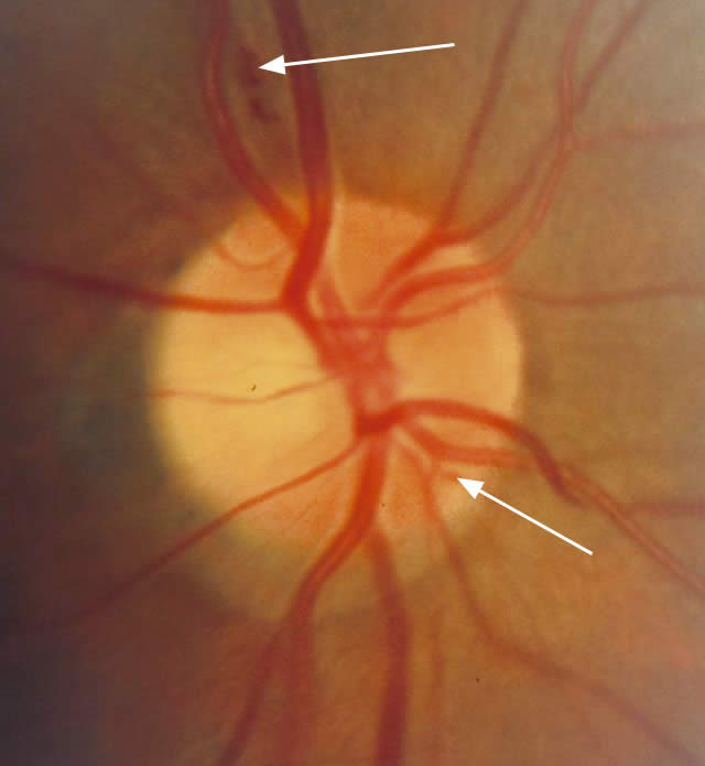 Community Eye Health Journal » The optic nerve head in glaucoma