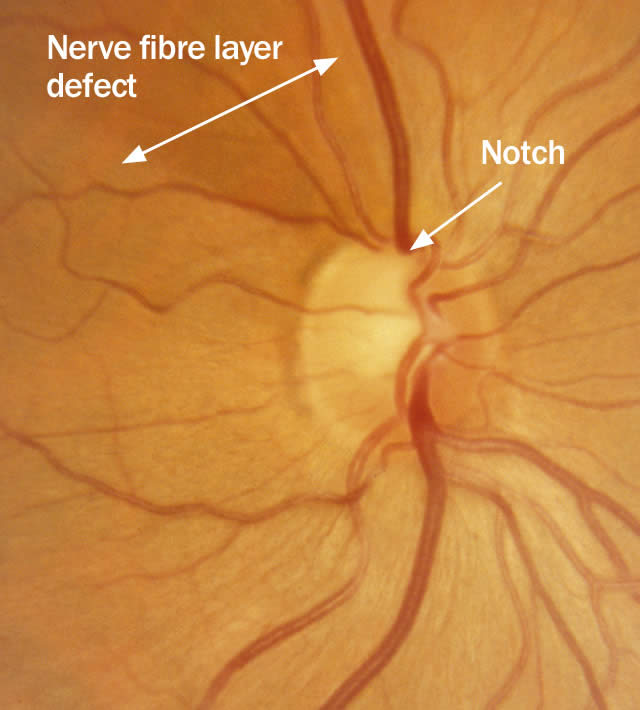 Community Eye Health Journal » The optic nerve head in glaucoma
