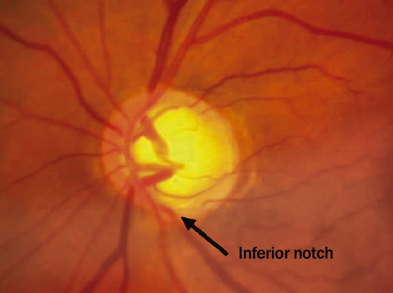 Community Eye Health Journal » How to assess a patient for glaucoma