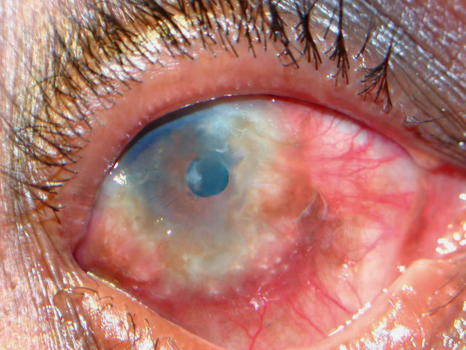Community Eye Health Journal » Vernal keratoconjunctivitis