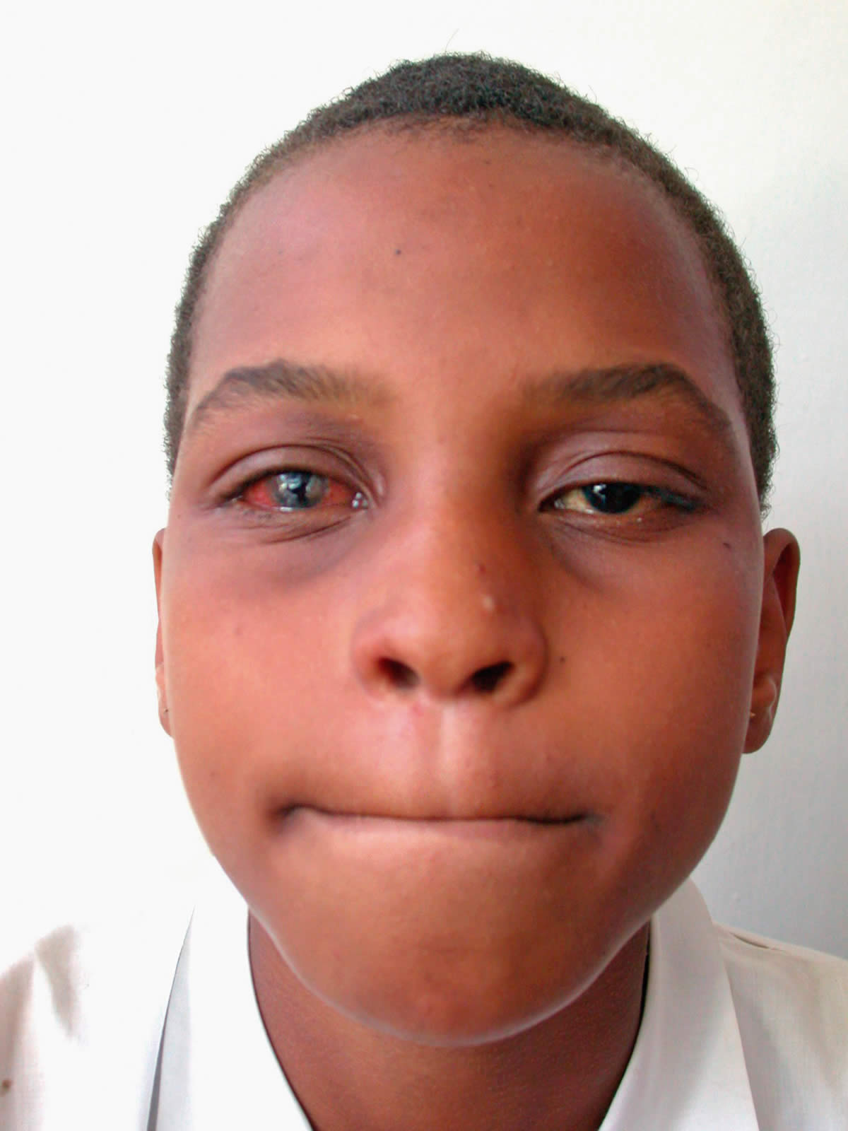 Community Eye Health Journal » Vernal keratoconjunctivitis