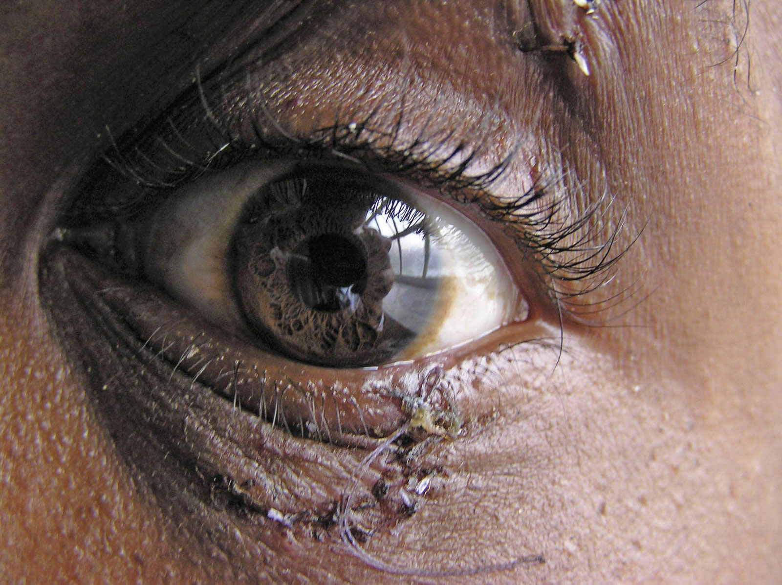 Community Eye Health Journal » Assessing and managing eye injuries