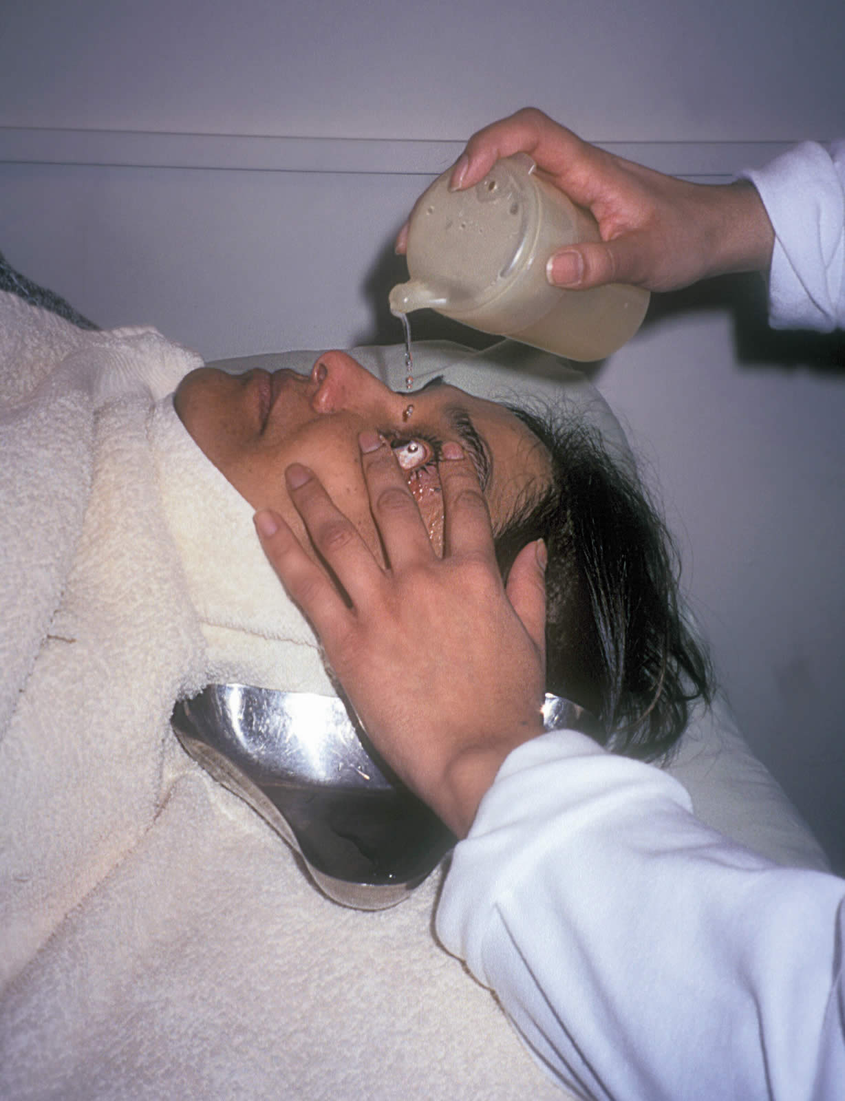 Community Eye Health Journal » How to irrigate the eye