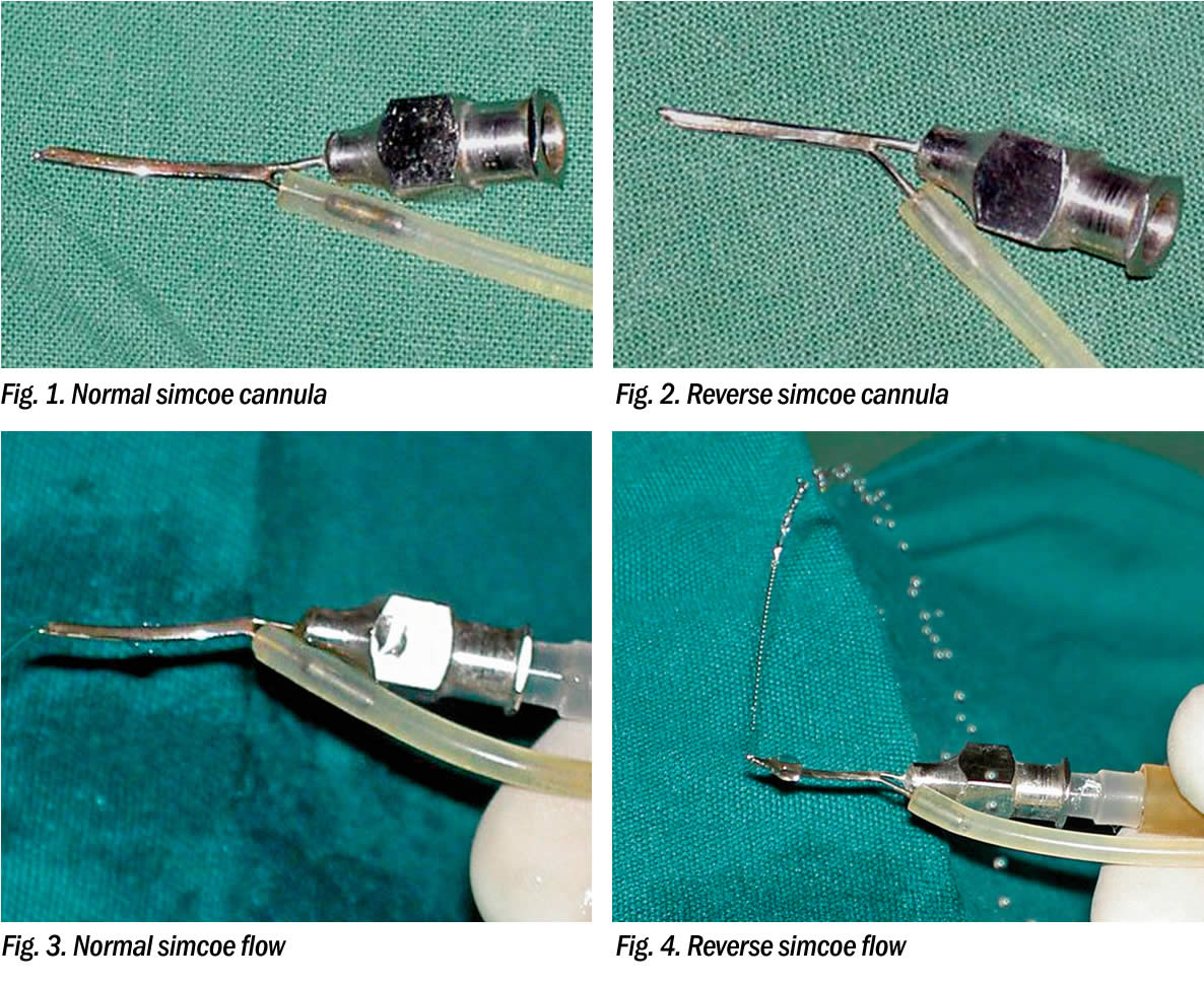 Community Eye Health Journal » Simcoe cannula construction can endanger ...