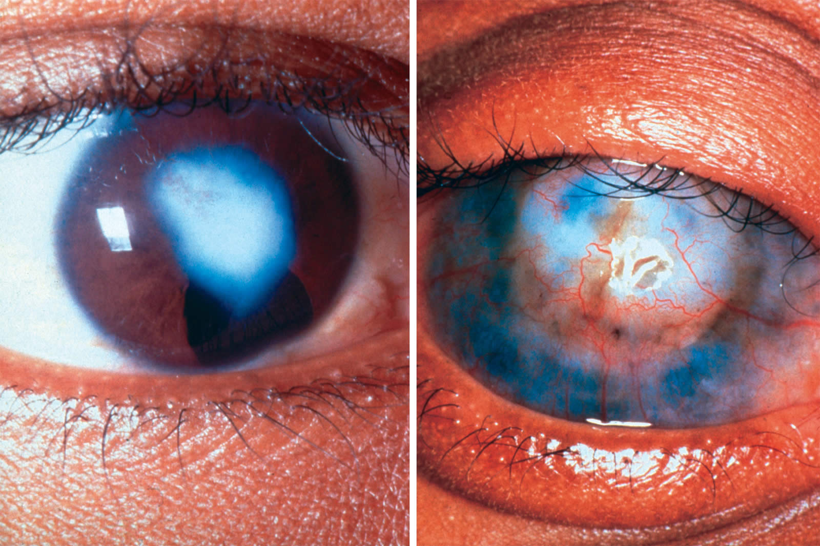 Community Eye Health Journal » Letter. How can we help blind children?