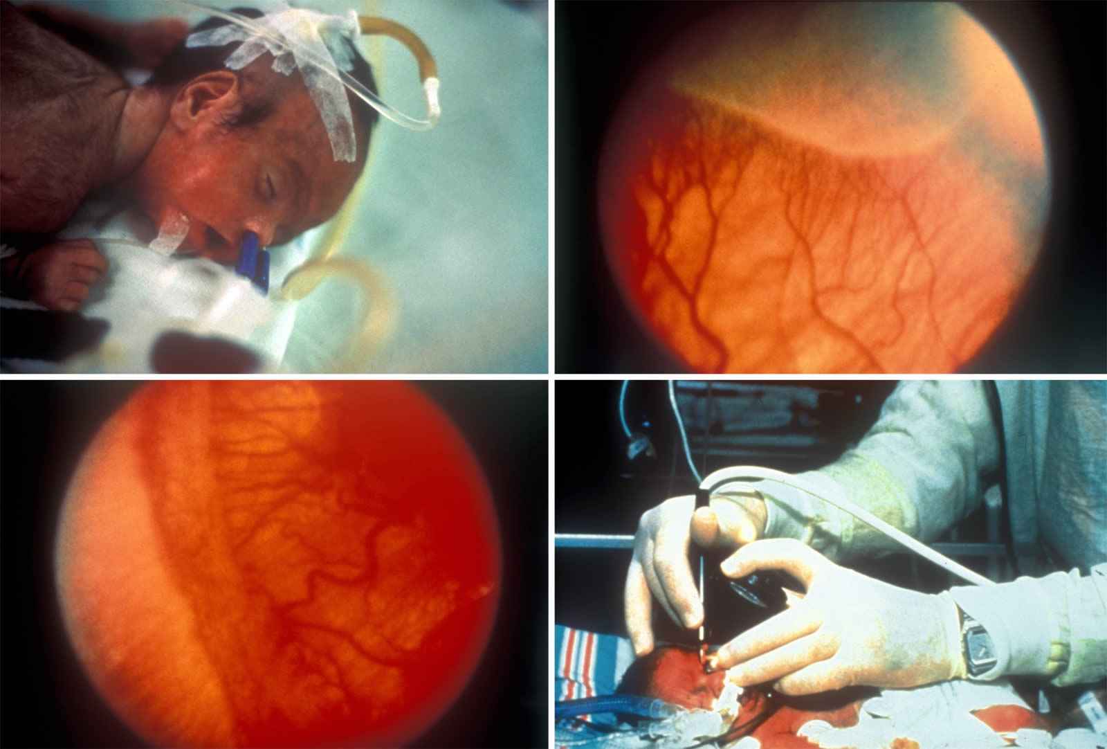 Community Eye Health Journal » The increasing problem of retinopathy of ...