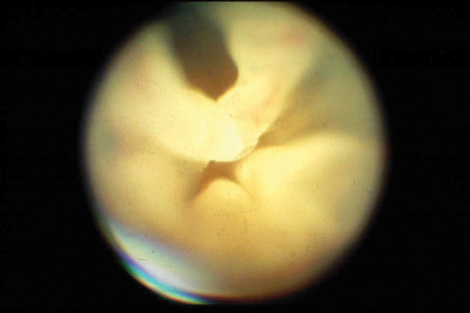 Community Eye Health Journal » Retinal detachment