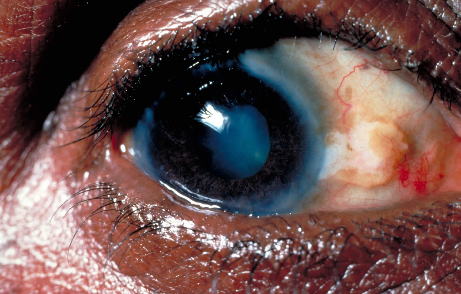 Community Eye Health Journal » Clinical grading system