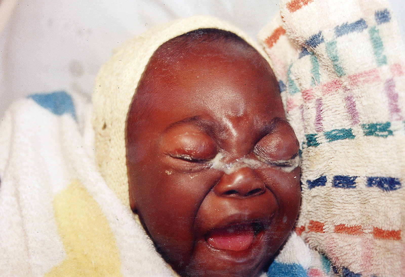Community Eye Health Journal » Ocular manifestations of child abuse