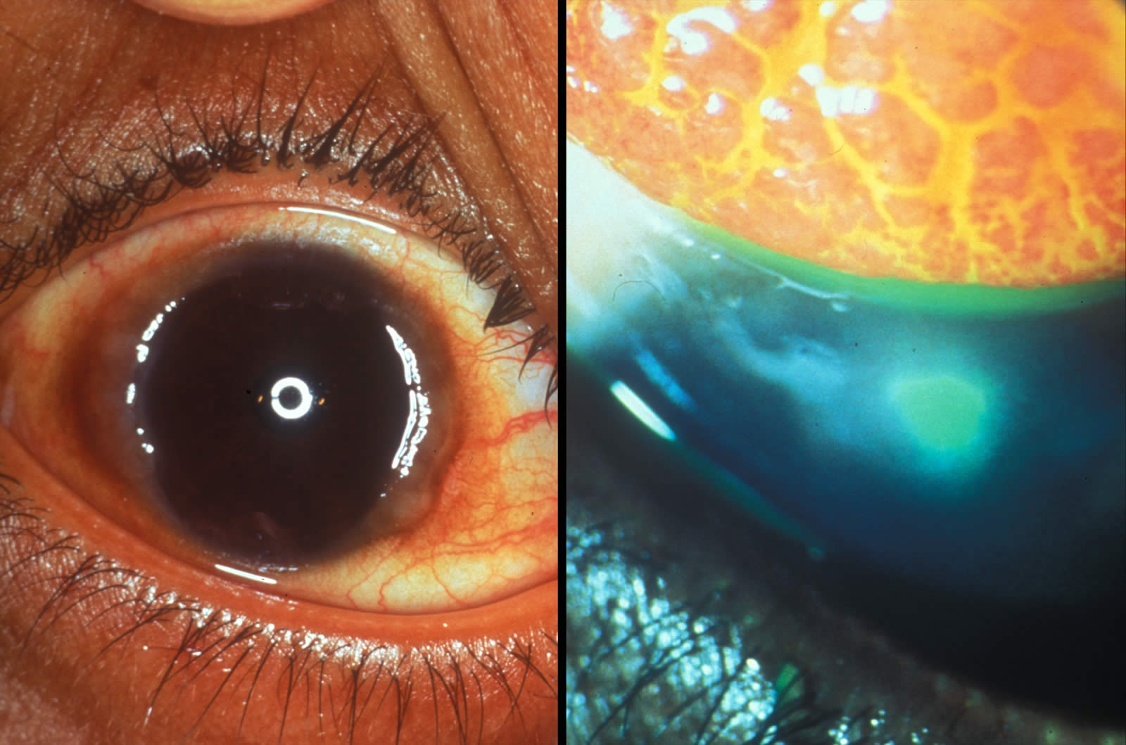 Community Eye Health Journal » The clinical picture of vernal kerato ...