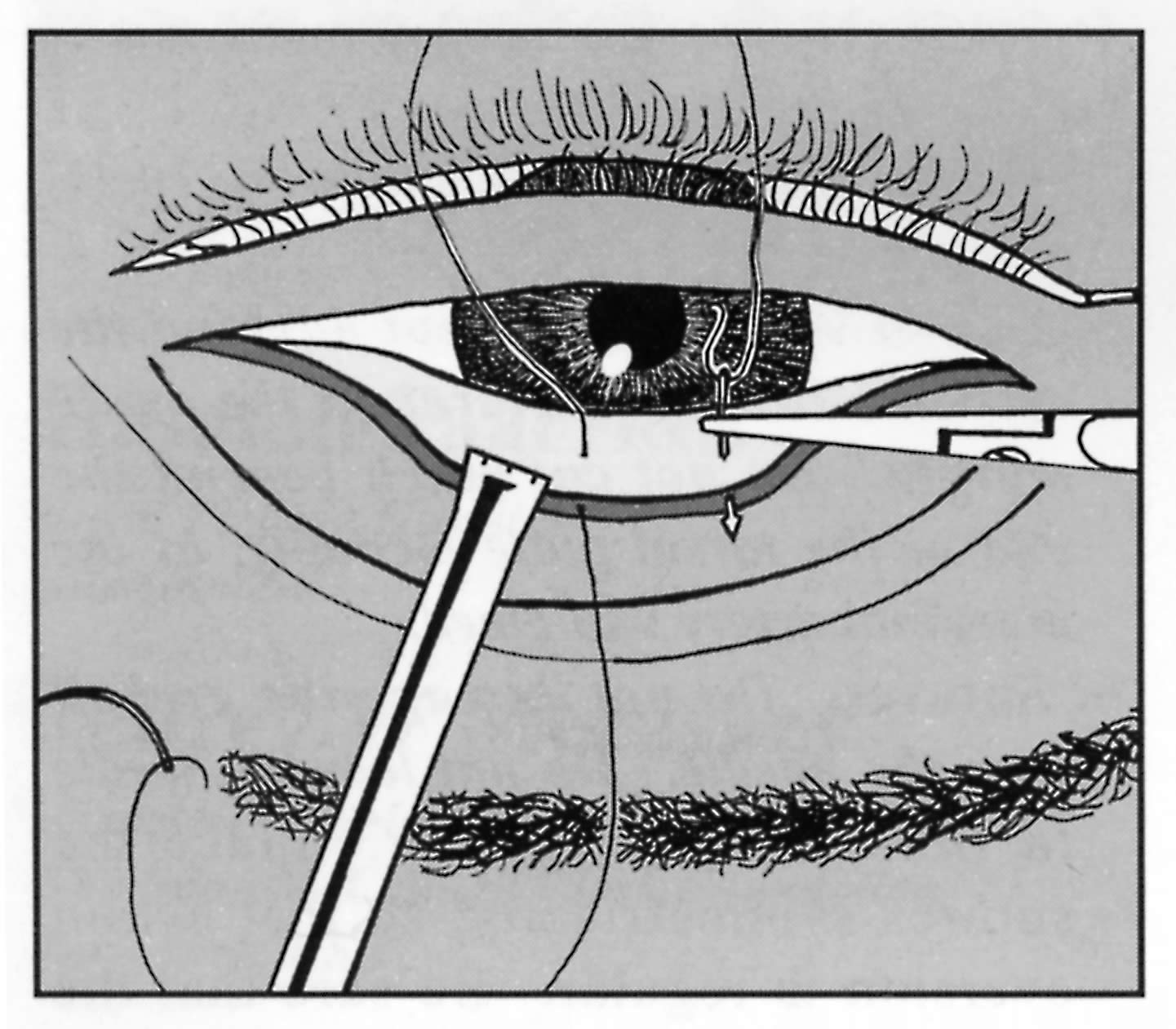 Community Eye Health Journal » Trichiasis surgery