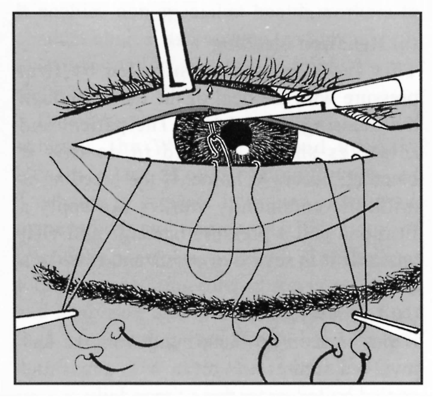 Community Eye Health Journal » Trichiasis surgery