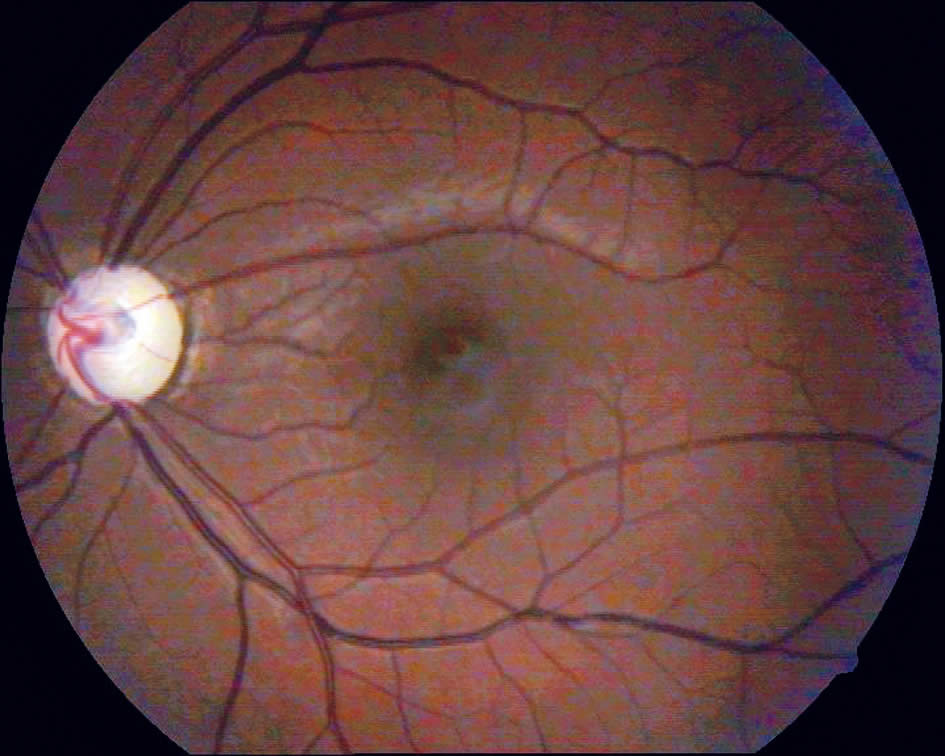 Community Eye Health Journal » Managing a patient with open-angle ...