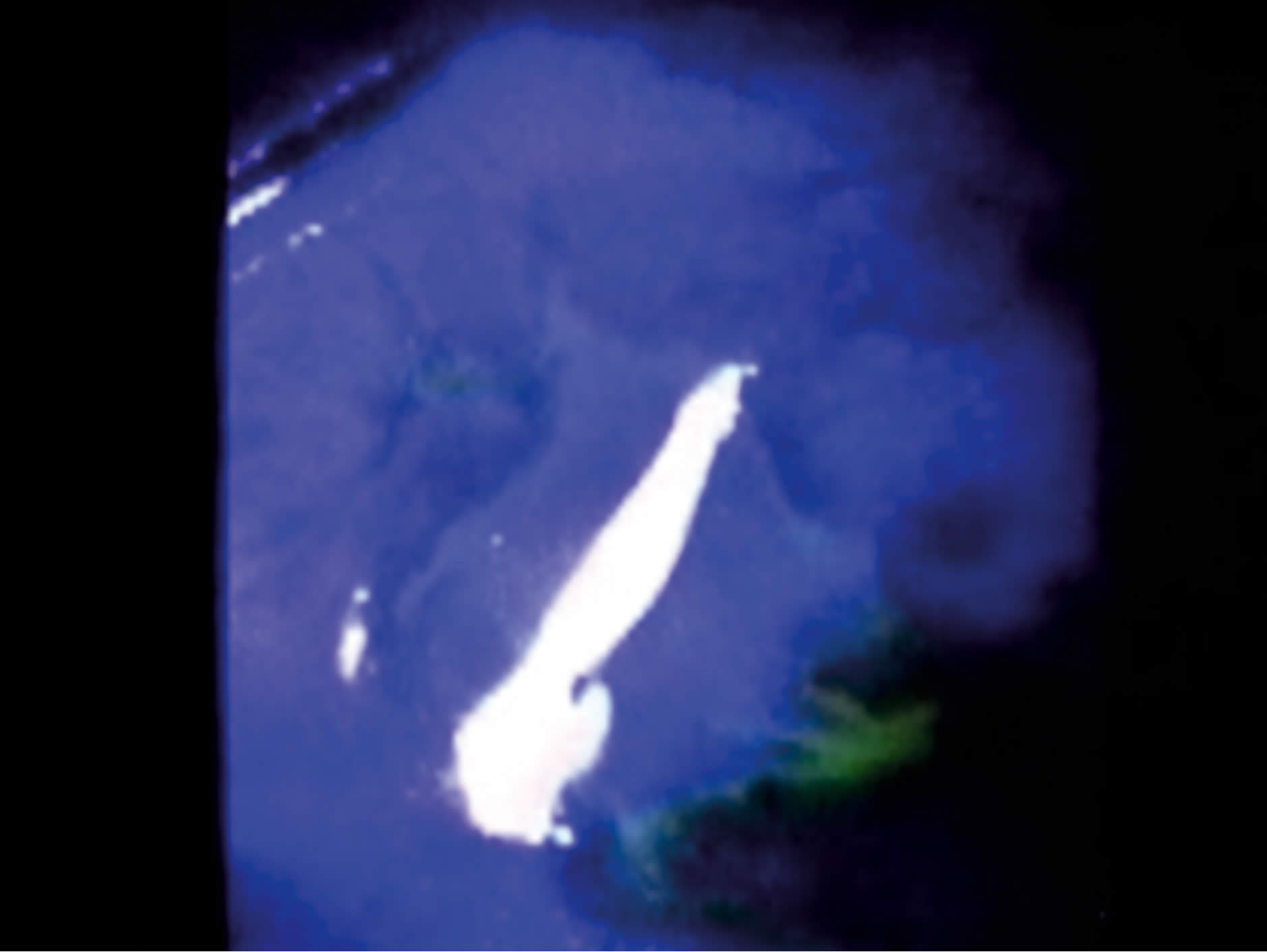 Community Eye Health Journal » Post-operative management of ...