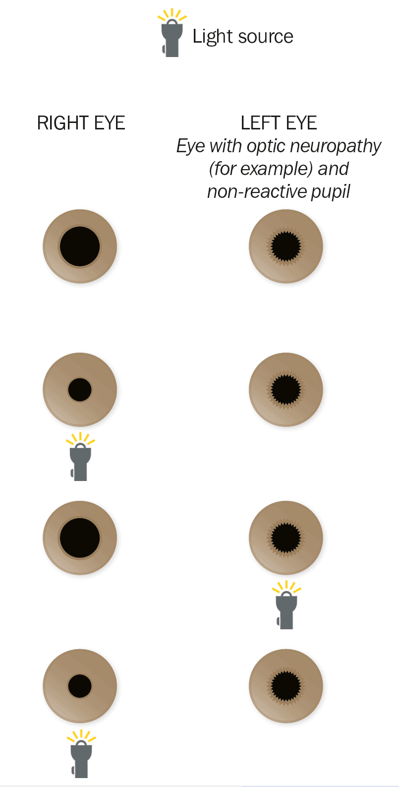 Community Eye Health Journal » How to test for a relative afferent ...