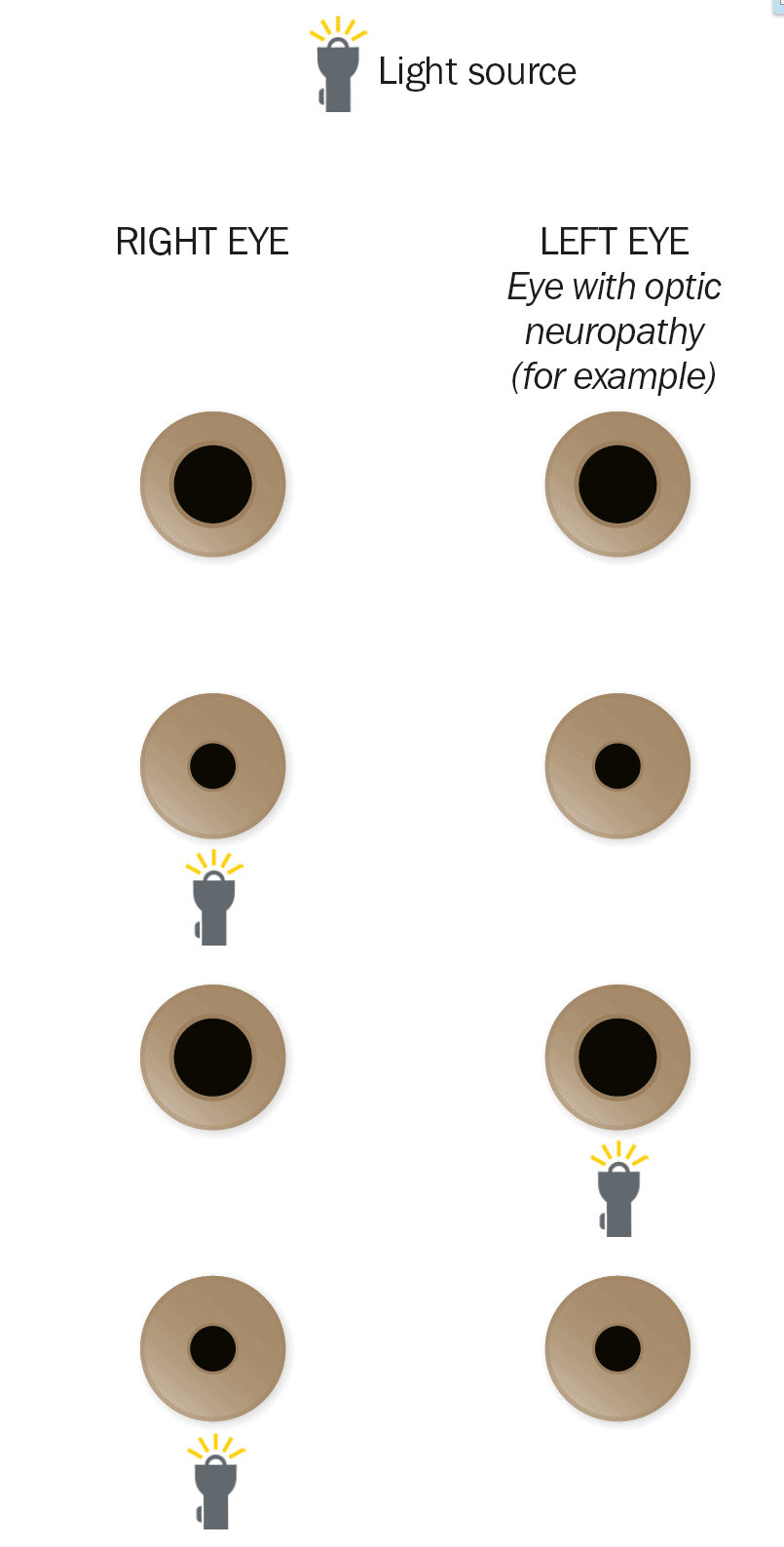 Community Eye Health Journal » How to test for a relative afferent ...