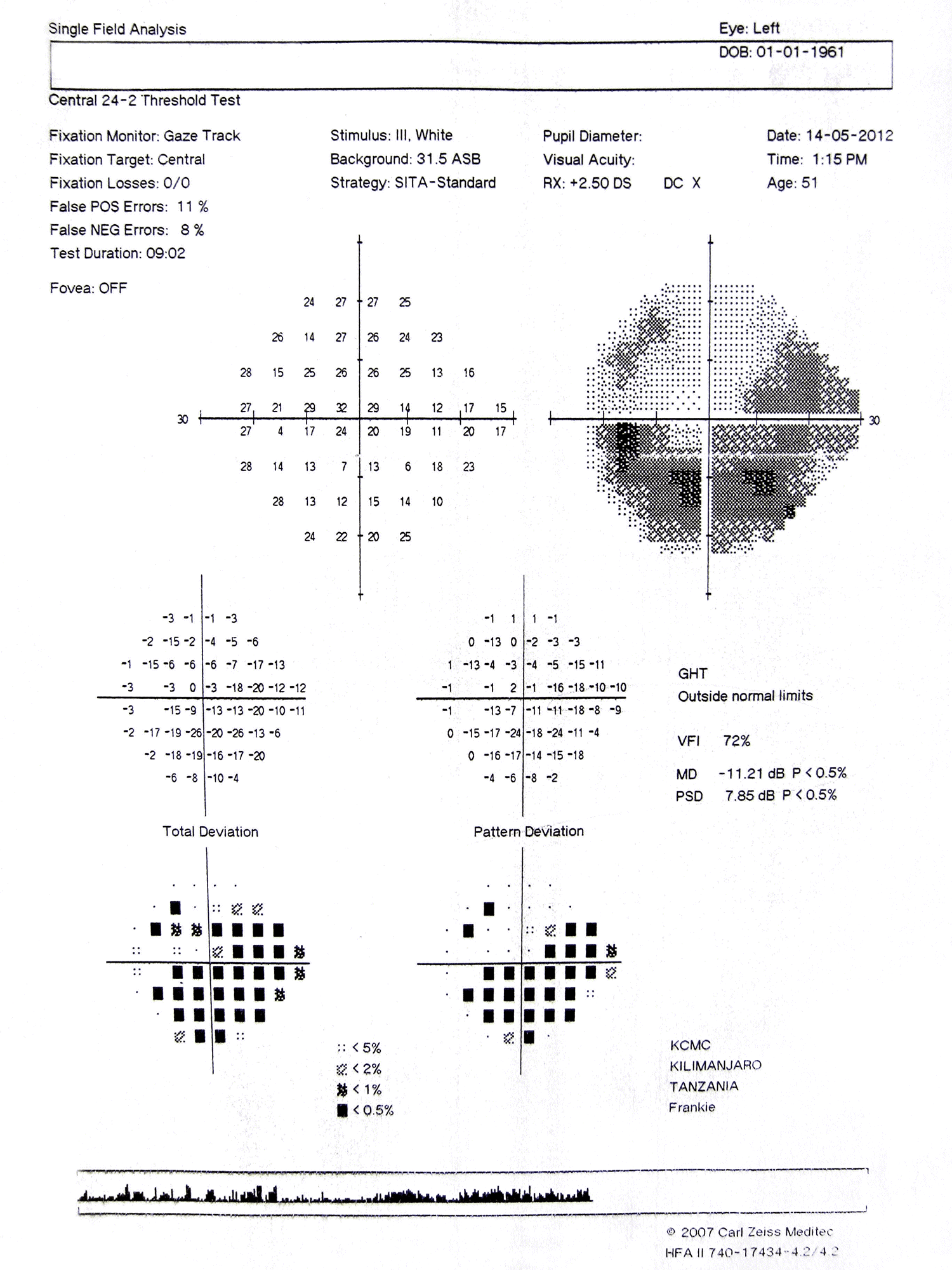 Community Eye Health Journal » Visual field testing for glaucoma – a ...