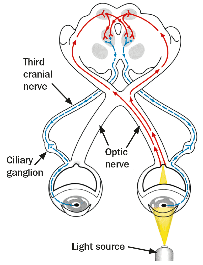 Community Eye Health Journal » How to test for a relative afferent ...