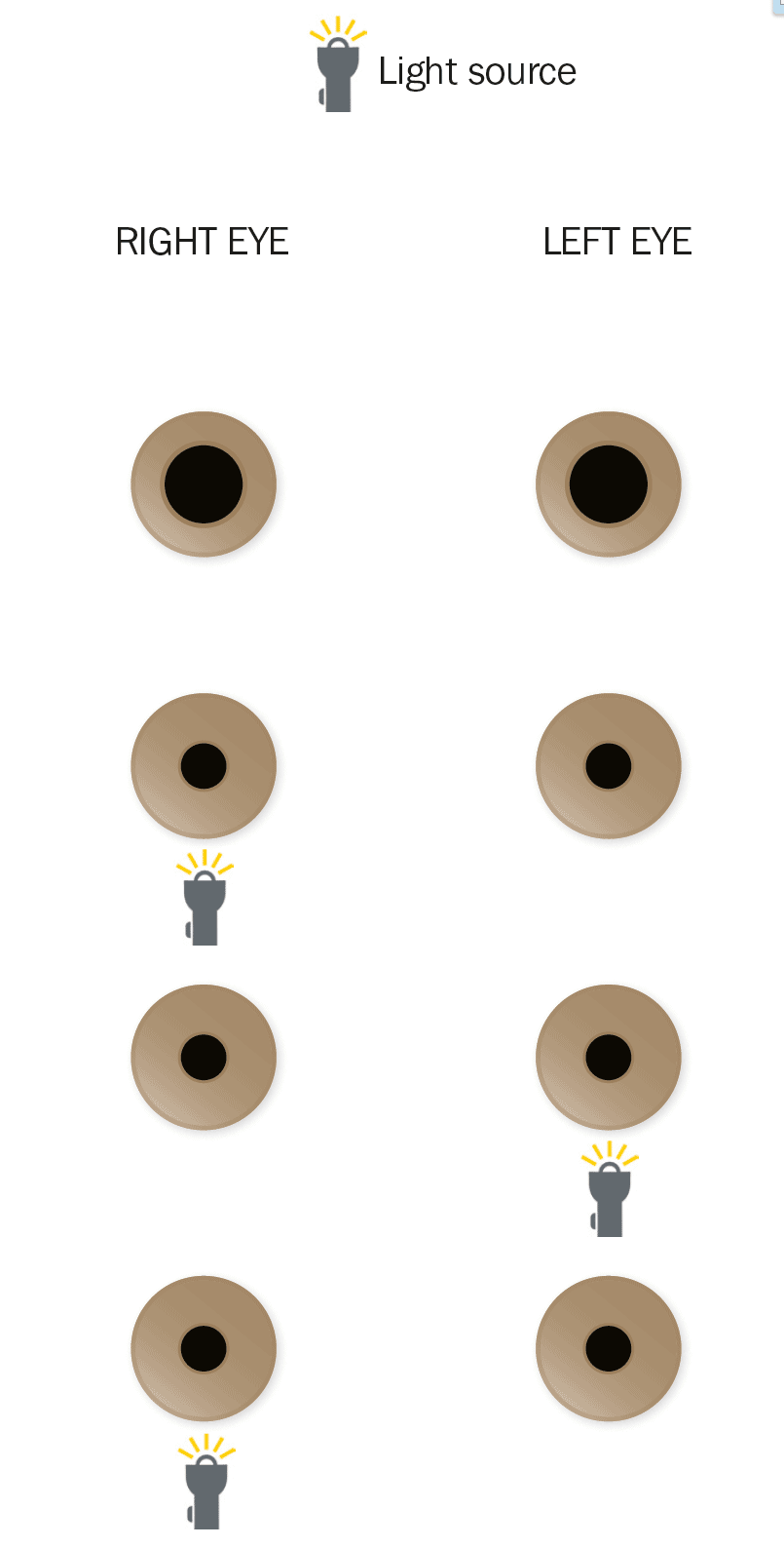 Community Eye Health Journal » How to test for a relative afferent ...