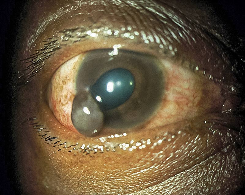 Community Eye Health Journal » Emergency management: penetrating eye ...