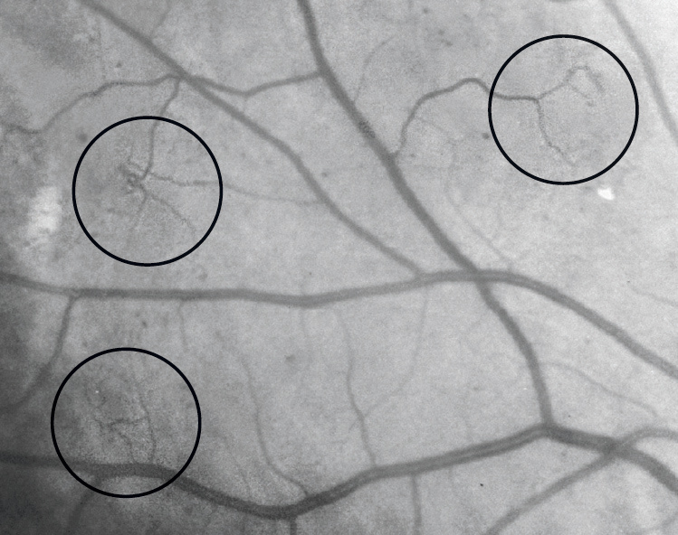 Community Eye Health Journal » Recognising and managing diabetic ...