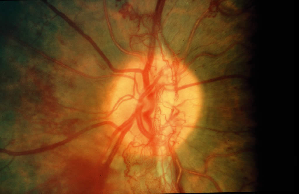 Community Eye Health Journal » Recognising and managing diabetic ...