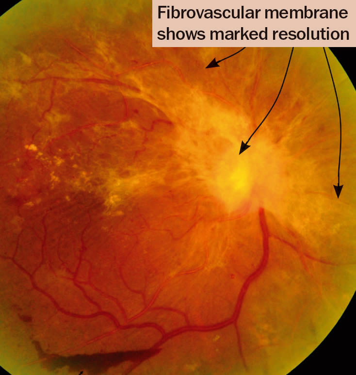 Community Eye Health Journal » Recognising and managing diabetic ...