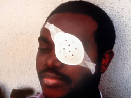 Community Eye Health Journal » How to apply an eye pad, shield, and bandage