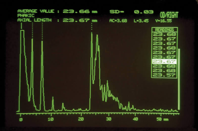 Community Eye Health Journal » How to avoid mistakes in biometry