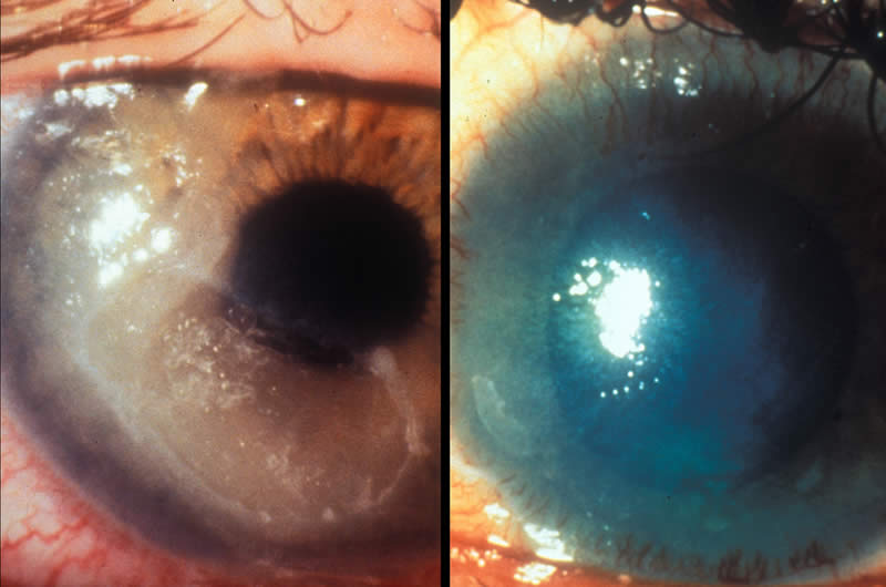 Community Eye Health Journal » Eye in primary health care teaching set ...