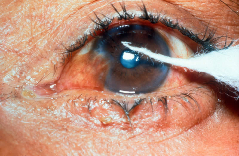 Community Eye Health Journal » Leprosy and the eye teaching set. Full text