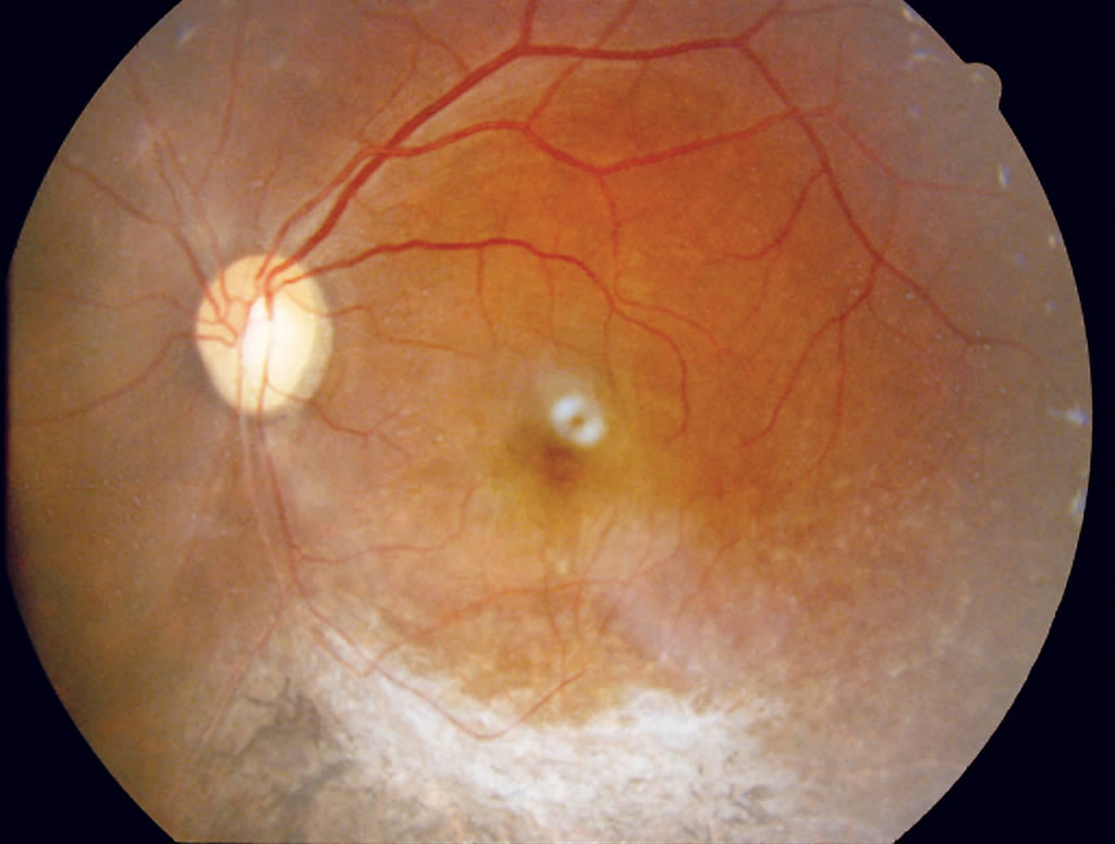 Cytomegalovirus Retinitis Cytomegalovirus Retinitis And Retinal