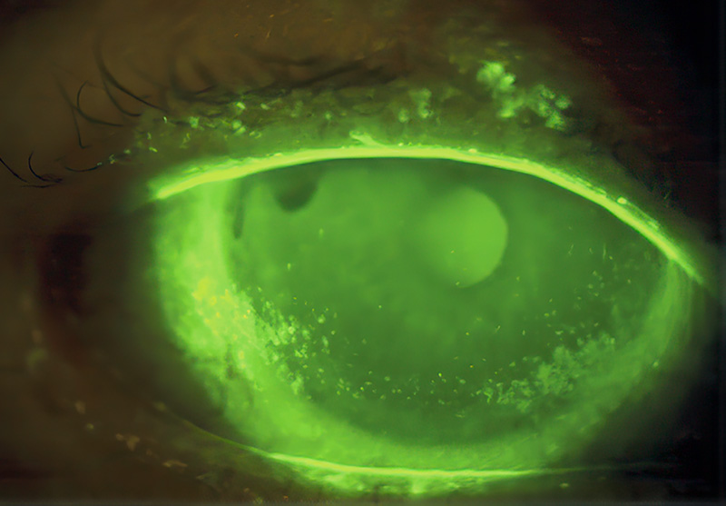 Community Eye Health Journal » Managing dry eye disease