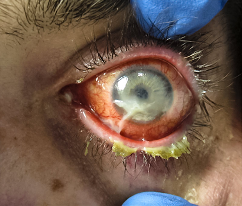 Community Eye Health Journal » Emergency management: exposure keratopathy